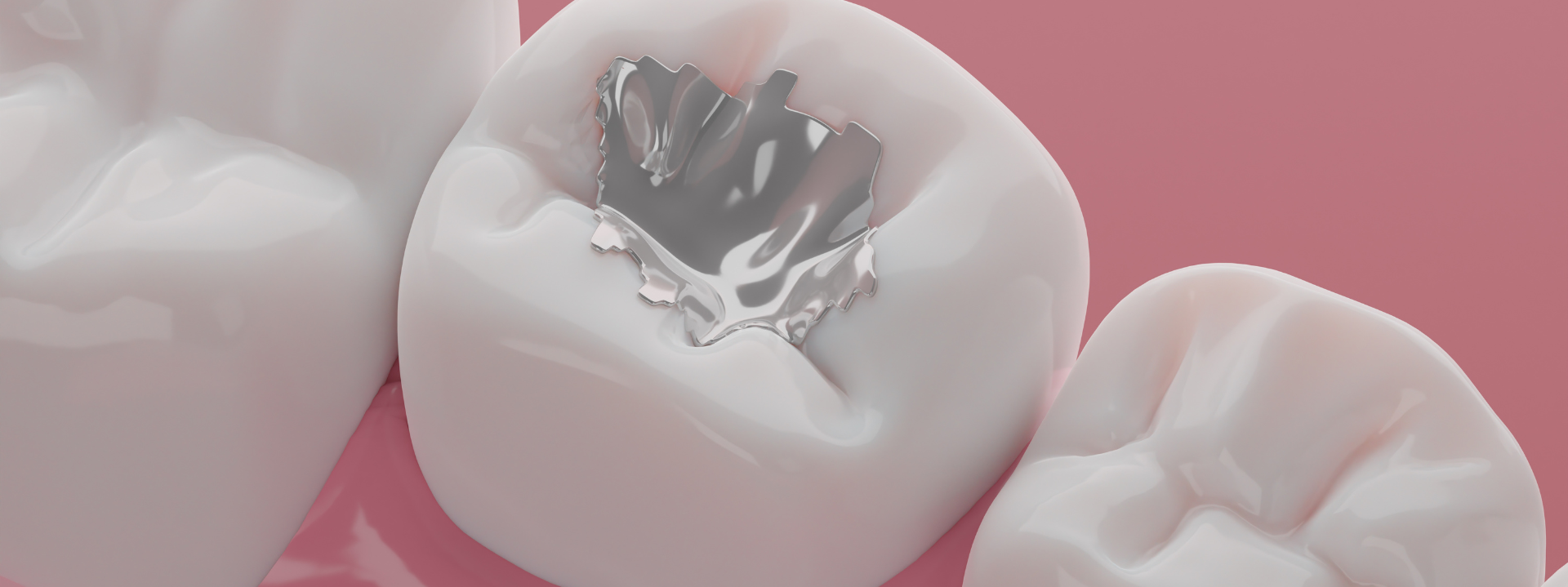 Amalgam ban 2025: What you need to know – alternatives and tips